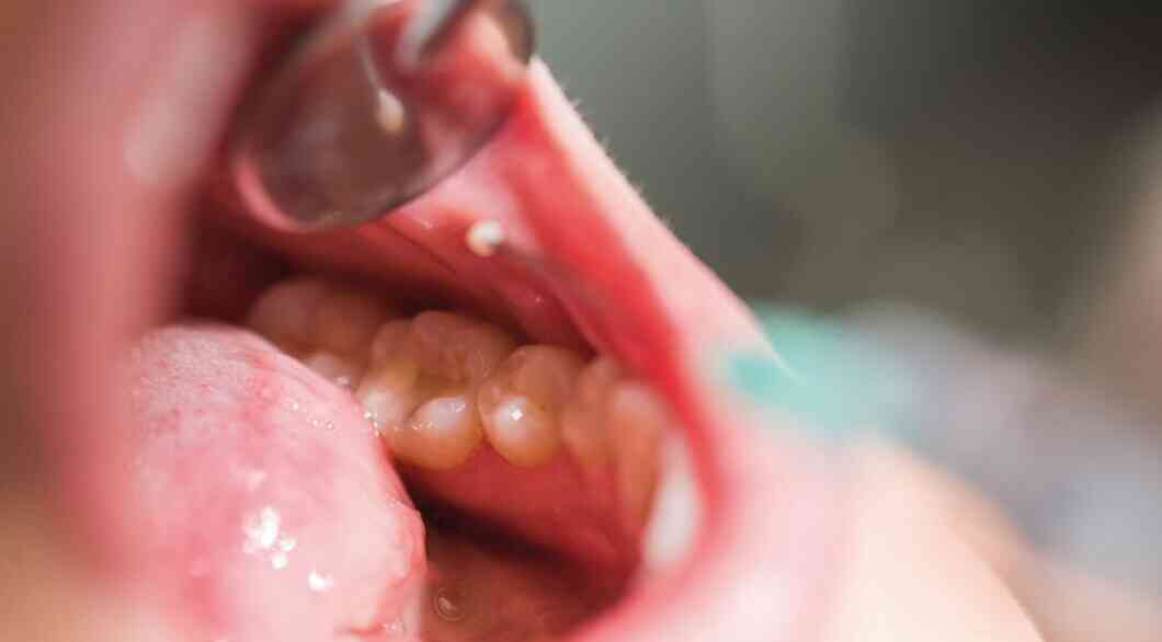 Oral Cancer Surgery: Diagnosis and Treatment Strategies - MindxMaster