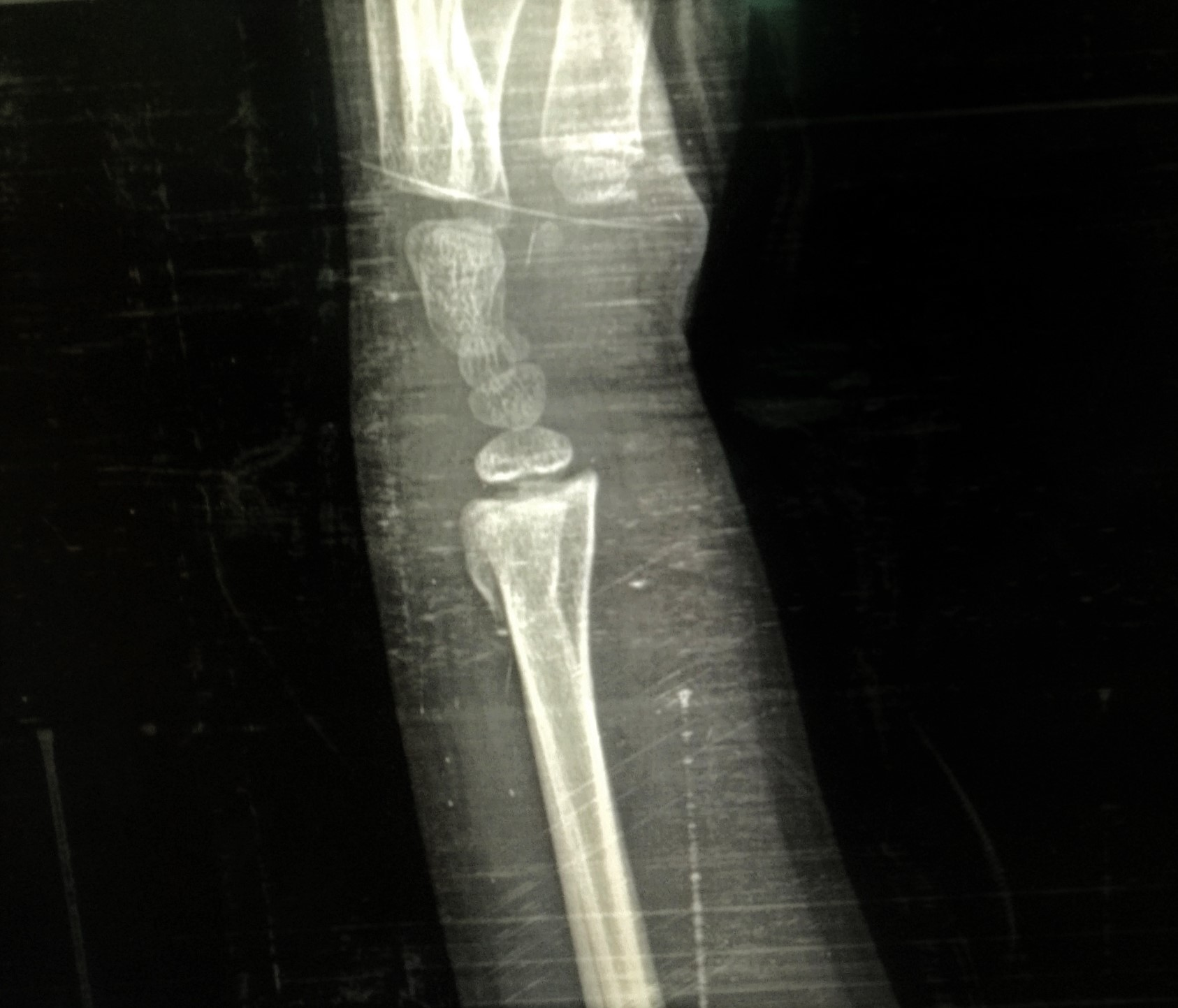 Top 5 Powerful Tips to Treat a Greenstick Fracture Fast - MindxMaster